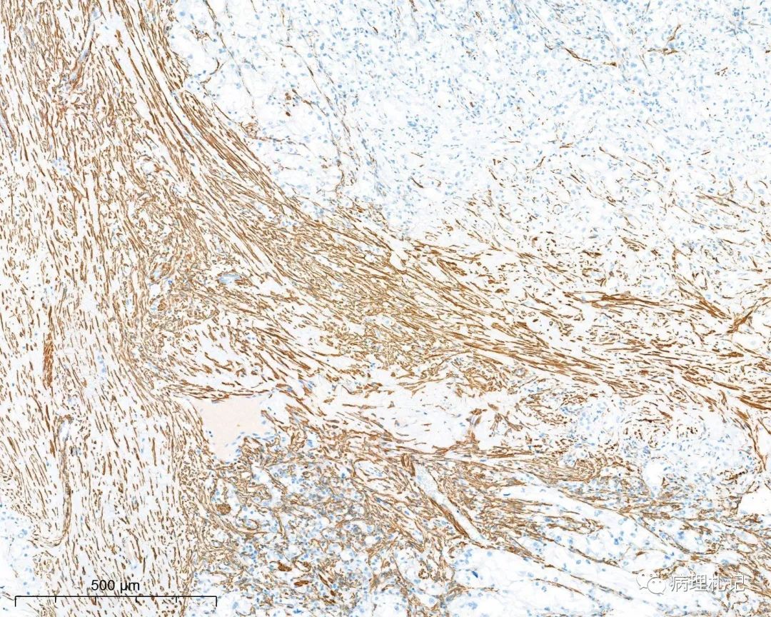 病理视角|细胞学BAP1表达缺失的非典型恶性间皮瘤_医学界-助力医生临床决策和职业成长