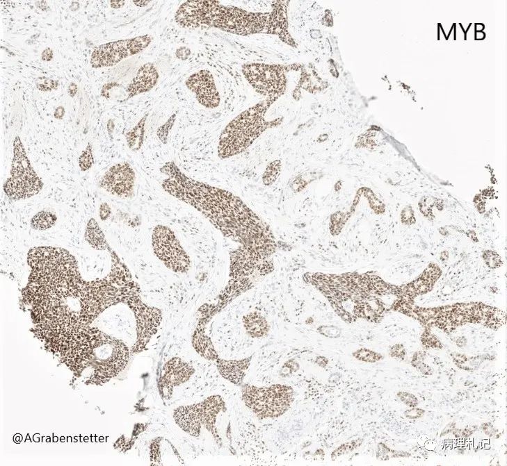 面对多形性「肉瘤样」肿瘤，排除非肉瘤样病变的可能性_医学界-助力医生临床决策和职业成长