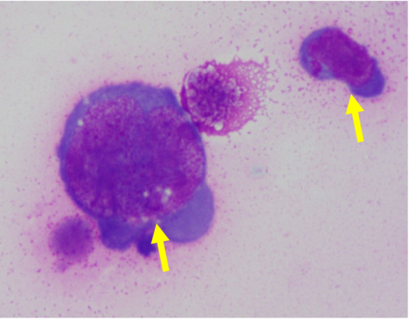 NK细胞淋巴瘤伴噬血细胞综合征一例_医学界-助力医生临床决策和职业成长