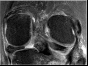 半月板后根撕裂分型图解_医学界-助力医生临床决策和职业成长