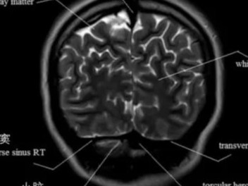 神经影像：开环征（open-ring sign）_医学界-助力医生临床决策和职业成长