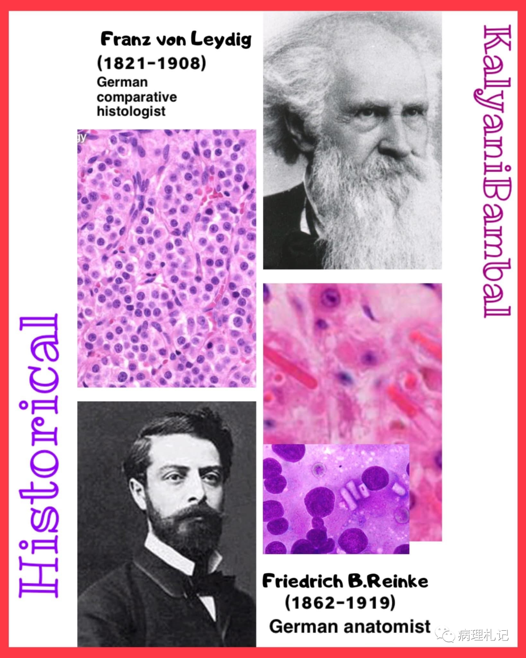 病理：透明血管型Castleman病免疫表型特征分析_医学界-助力医生临床决策和职业成长